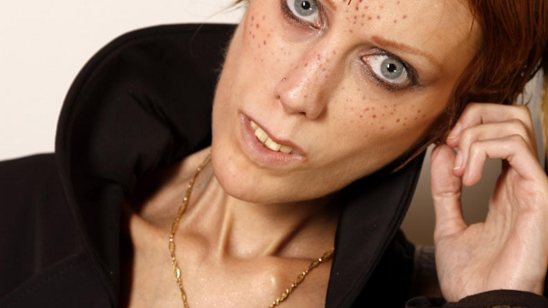 Magermodel Isabelle Caro ist tot