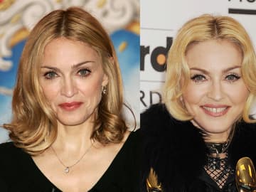Vorher & Nachher: Diese Stars hatten Botox-Behandlungen