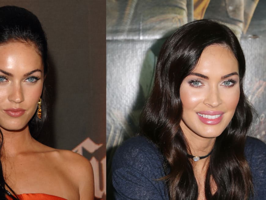 Vorher & Nachher: Diese Stars hatten Botox-Behandlungen